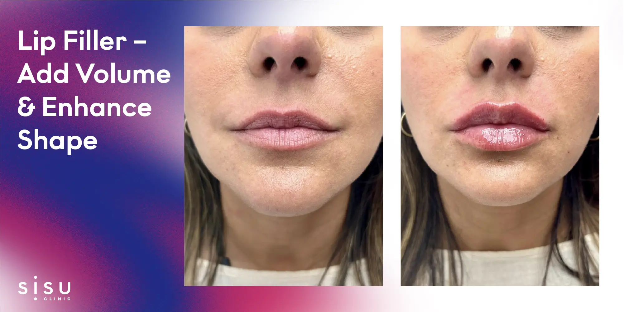 Lip Flip vs. Lip Filler in Ireland: Best Treatment for Natural Lips?